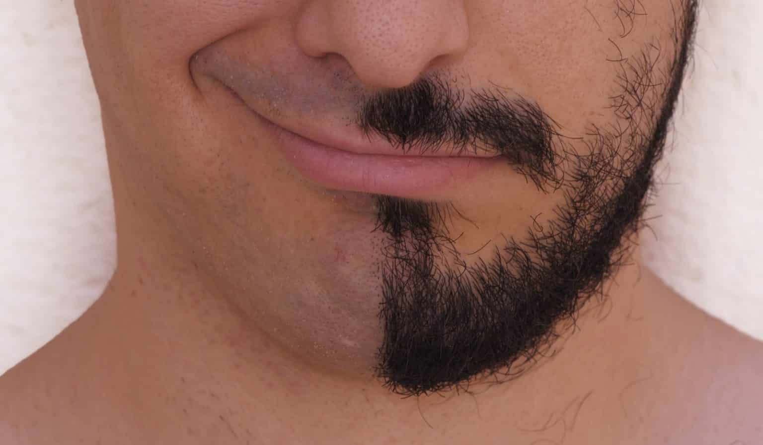 Dünner Bart - Dickes Problem? Ursachen und Lösungen - Heisenbeard ...