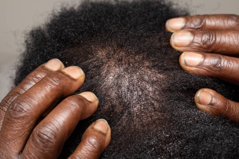 Diffuser Haarausfall: Was steckt dahinter und wie kann man ihn behandeln?